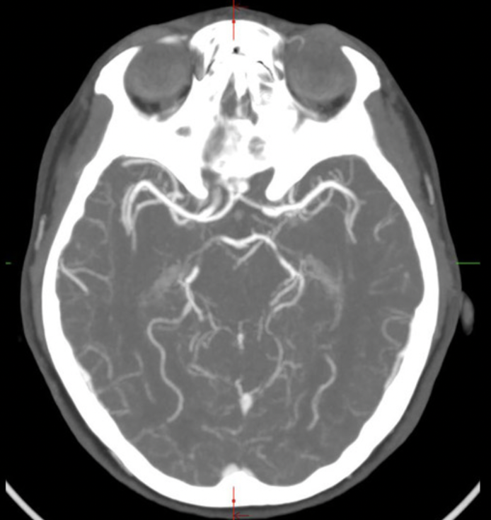 Cerebrovascular Tests - AANS/CNS Cerebrovascular Section
